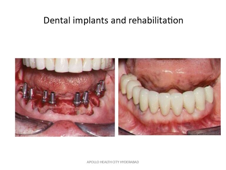 Jaw Bone Cancer Treatment in KPHB | Expert Mandibulectomy