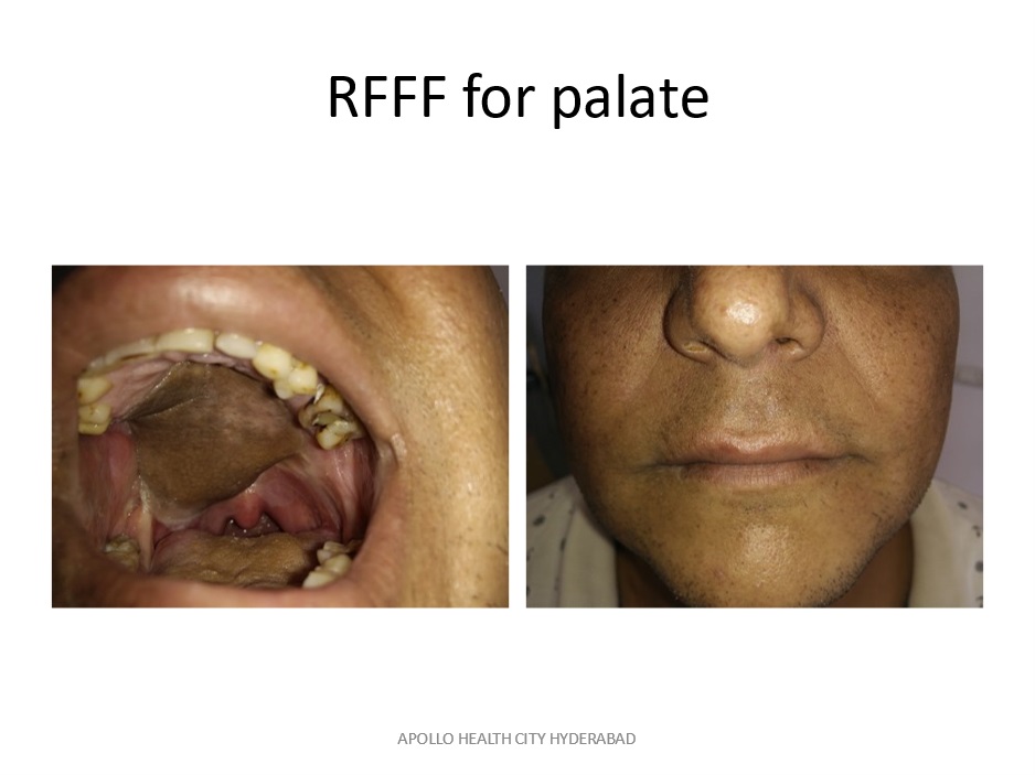 Palate Cancer treatment in KPHB | Specialist in Hyderabad