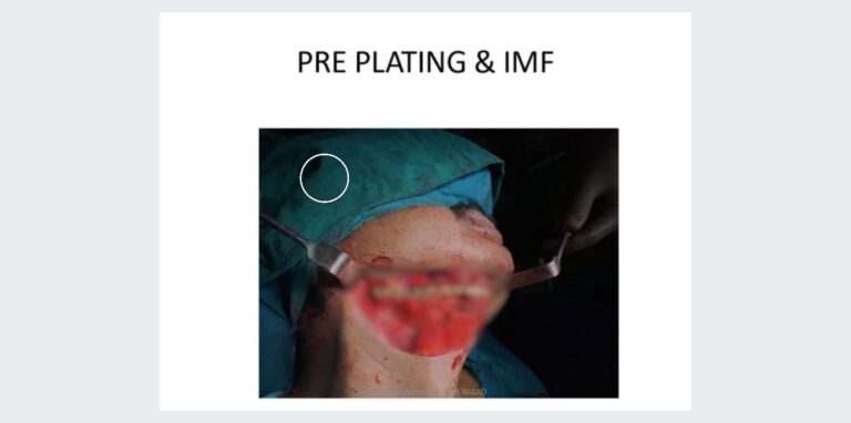 Jaw Bone Cancer Treatment in KPHB | Oral Cancer Specialist