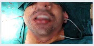 Jaw Bone Cancer Treatment in KPHB | Expert Mandibulectomy